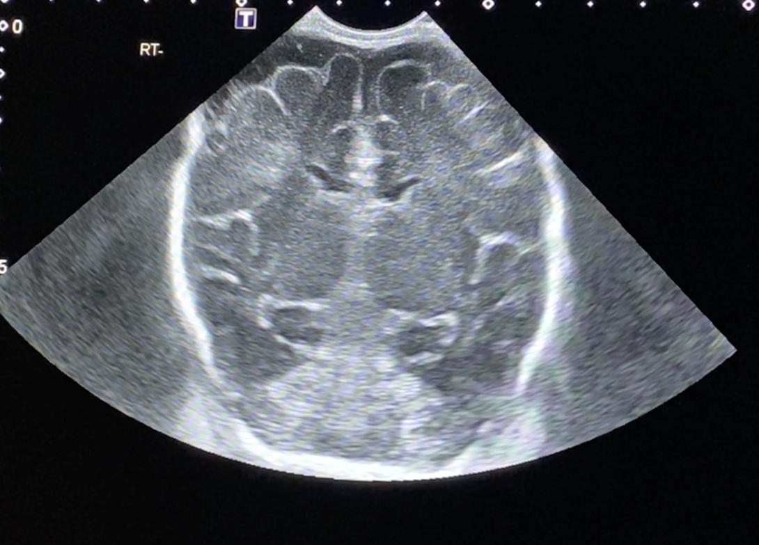 Introduction To Neonatal Cranial Ultrasound Paedshub